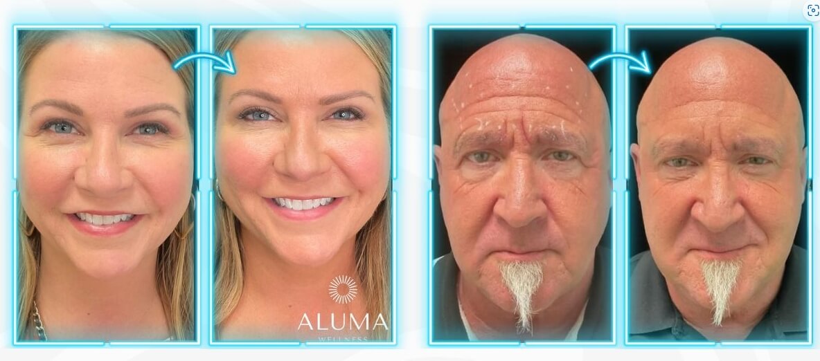 Christmas Botox Special - Aluma Wellness
