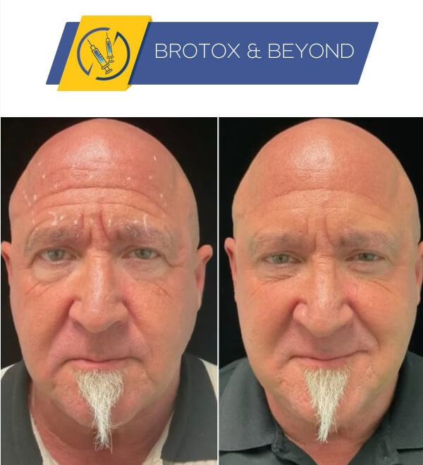 Brotox treatment: Includes 60 units of Botox - Aluma Wellness